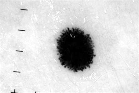 Result Of Applying Intensity Adjustment Step On The Dermoscopy Image Of