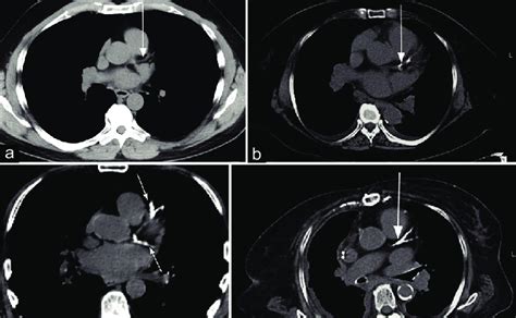 A Axial Computed Tomography Attenuation Correction Image Shows Zero Download Scientific