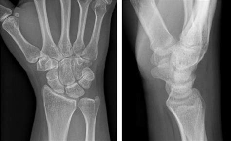 I Have A Broken Wrist A Primer On Distal Radius Fracture Surgery — Dr Nick Golinvaux