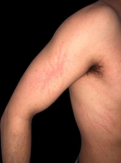 Red Lines Appear On Skin