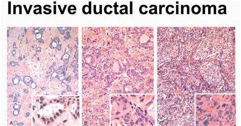 Invasive Ductal Carcinoma