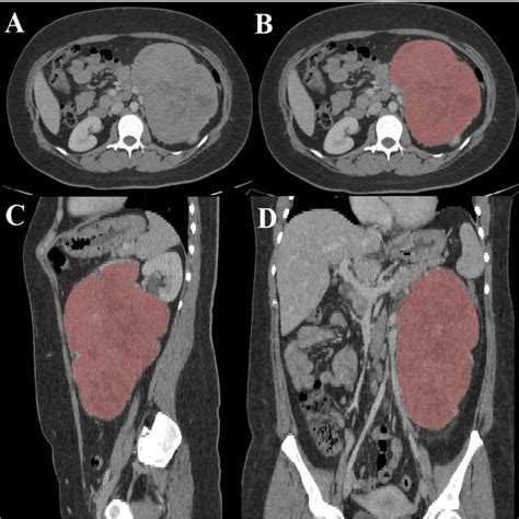 Ct Scan Of The Abdomen A Showing Left Adrenal Mass The Adrenal Mass Download Scientific