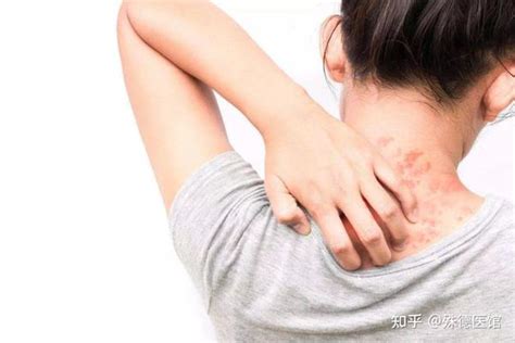 换季就过敏你的皮肤还有救吗 知乎
