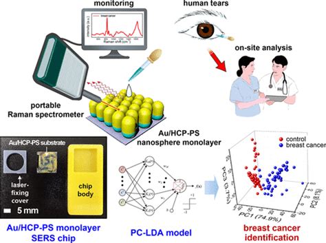 Label Free Surface Enhanced Raman Spectroscopy Biosensor For On Site Breast Cancer Detection