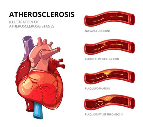 Atherosclerosis Stages