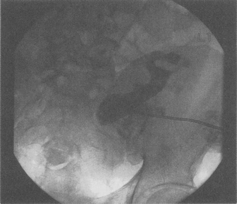 This Percutaneous Nephrostogram Demonstrates The Collecting System Of