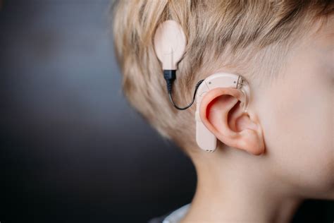 29 Facts About Cochlear Implant