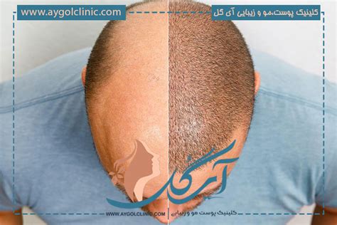 آشنایی با روش‌های کاشت مو Fit، Fut و ترکیبی