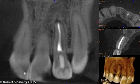 Cone Beam Computed Tomography In Endodontics The Best Picture Of Beam
