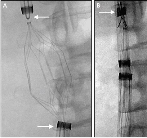 Endovascular Today Current Ivc Filter Retrieval Techniques July 2017 Endovascular Today Current Ivc Filter Retrieval Techniques July 2017