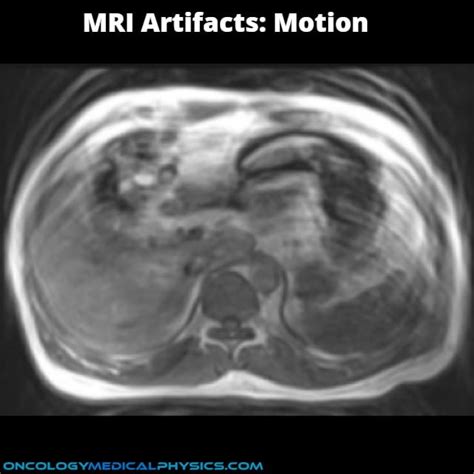 Mri Artifacts Oncology Medical Physics