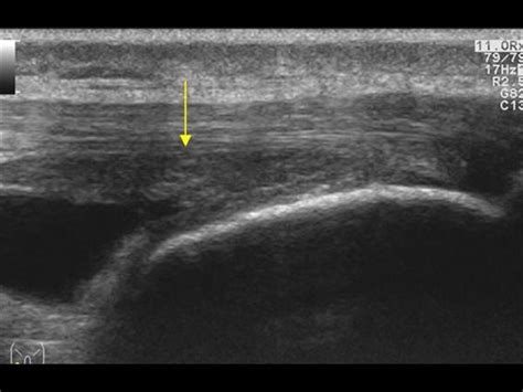 Musculoskeletal Joints And Tendons 66 Knee Case 665 Distal