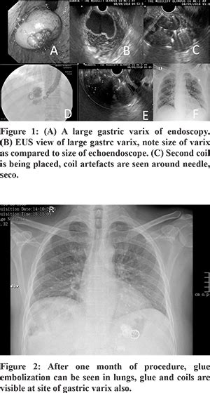 A Case Of Symptomatic Embolization After Eus Guided Coil And Glue For A