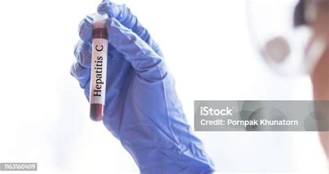 세계 간염의 날 개념입니다 C형 간염 바이러스를 가진 혈액 샘플 의료 장갑에 있는 실험실 기술자 손에 양성 C 형 간염에 대한