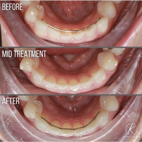 Invisalign Comprehensive Treatment Cost Kingston Orthodontics