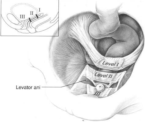 What Happens To Pelvic Floor After Hysterectomy