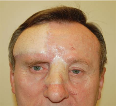 Figure 1 From Free Flap Reconstruction For Complex Scalp And Forehead Defects With Associated