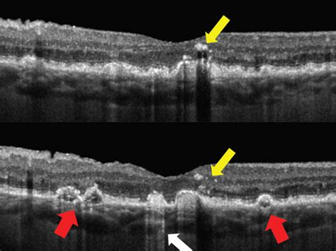 Oct An Indispensable Tool In Retina Care