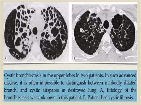 Presentation1 Pptx Radiological Imaging Of Bronchiectasis Pptx