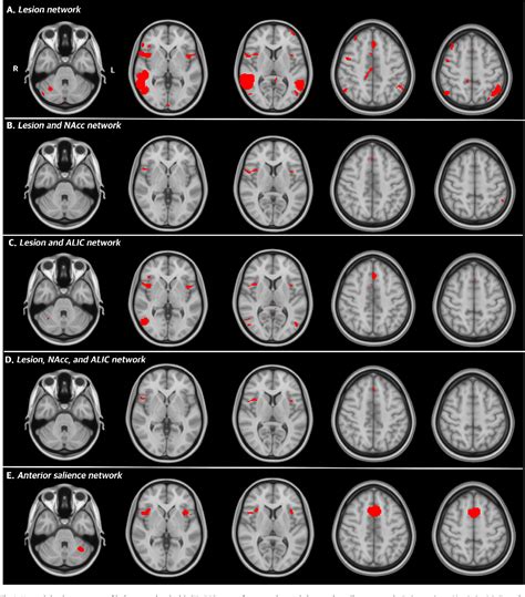 Figure 1 From Lesions Causing Self Injurious Behavior Engage Putative Networks Modulated By Deep