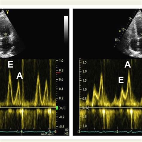 A Algorithm For Diagnosis Of Lv Diastolic Dysfunction In Subjects Download Scientific Diagram