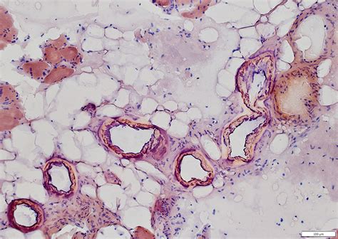 Calciphylaxis