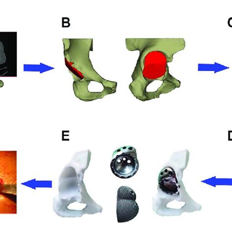 Clinical Application Of The Iap A Acetabular Cup Placement In True Download Scientific