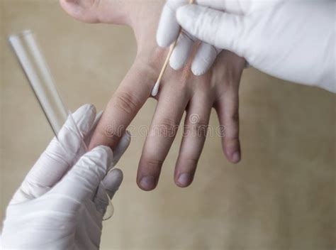 Dermatologist Collects Skin Swab Sample From Patient S Arm Using Cotton Swab And Test Tube