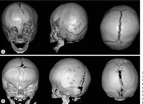 Figure 2 From Genetic Syndromes Associated With Craniosynostosis Semantic Scholar
