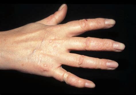 Mutilating Vohwinkel Palmoplantar Keratoderma With Deafness Key