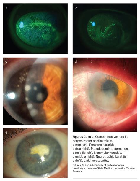 Herpes Zoster Ophthalmicus Pseudodendrite