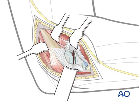 Lateral Approach To The Pediatric Distal Humerus