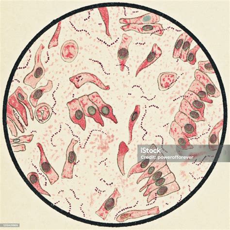 Pandangan Mikroskopis Jaringan Usus Dengan Bakteri Streptococcus Pyogenes Dari Pasien Dengan