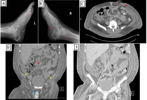 A Fatal Case Of Systemic Calciphylaxis In The Gastrointestinal Tract A