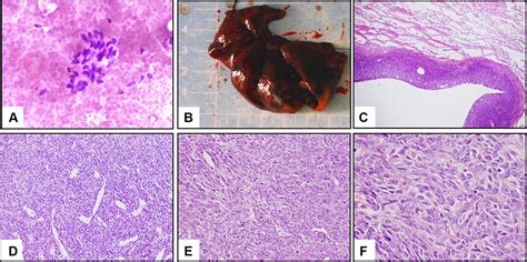 Rare Primary Pulmonary Primitive Neuroectodermal Tumor A Case Report Ott