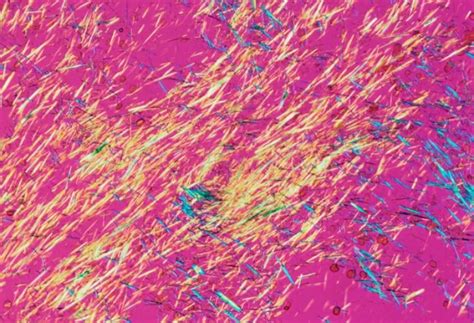 How Do Urate Crystals Stop Gout Forever Goutpal Gout Help