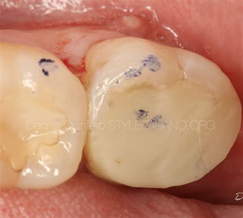 Intentional Replantation In Distal Root Defect Made By Wisdom Tooth Style Italiano Endodontics