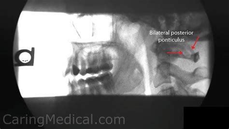 Understanding Ponticulus Posticus Treatments