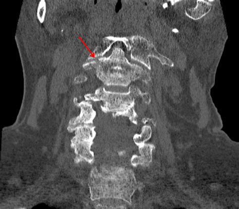 Odontoid Process Fracture