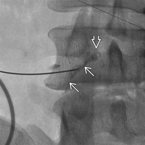 Selective Nerve Root Block Lumbar Spine Clinical Tree