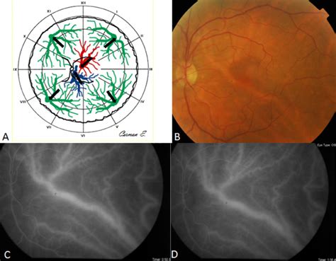A A Scheme To Demonstrate The Choroidal Drainage Green Vessels Show Download Scientific