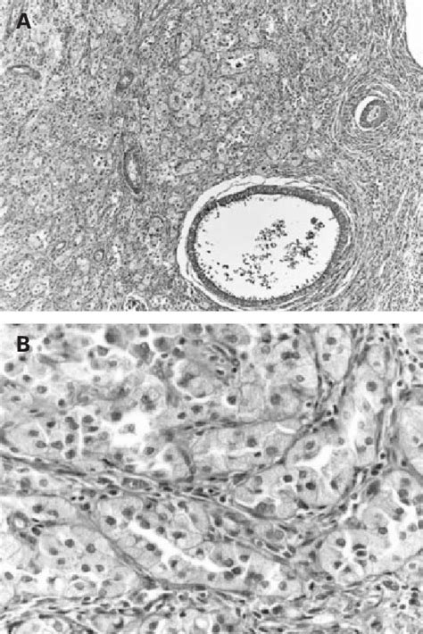 A Diffuse Luteinised Sex Cord Like Stroma Surrounds Cystic Gland B Download Scientific
