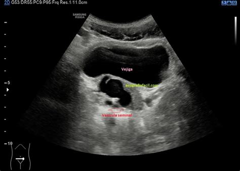 Vesícula Seminal Ecografía Fácil