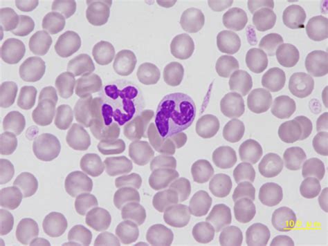 Segmented Neutrophils Nejm On X 🧵 Weekend Briefing For November