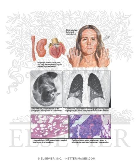 Systemic Sclerosis Scleroderma