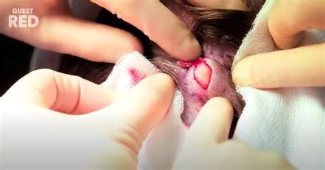 UK S Dr Pimple Popper Bursts Marble Shaped Cysts On Woman S Scalp In Gross New Video The US Sun
