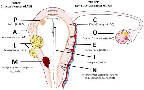 Abnormal Uterine Bleeding Aub — Avana Health