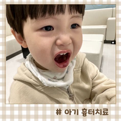 아기 입술 찢어짐 흉터 재생치료 및 관리방법 네이버 블로그