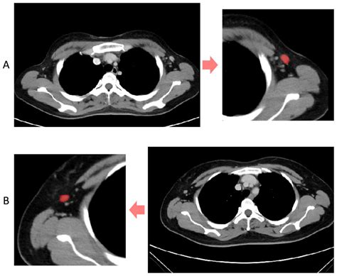 Segmentation Of The Region Of Interest A Shows The Segmentation Of A