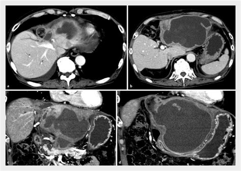 Computed Tomography Imaging Of Biloma Huge Bimola Connected To